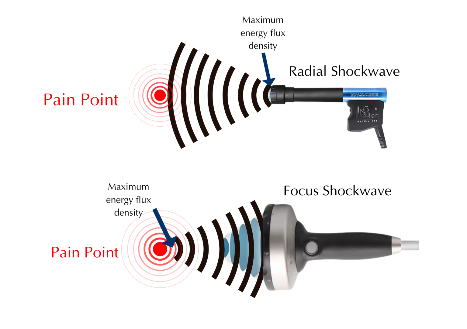 Verschillen tussen Gefocuste Shockwave Therapie (FSWT) en Radiale ...